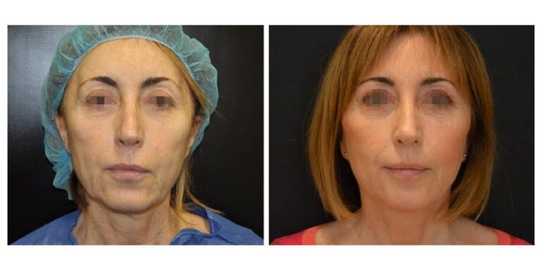 Lipofilling visage - chirurgie esthetique